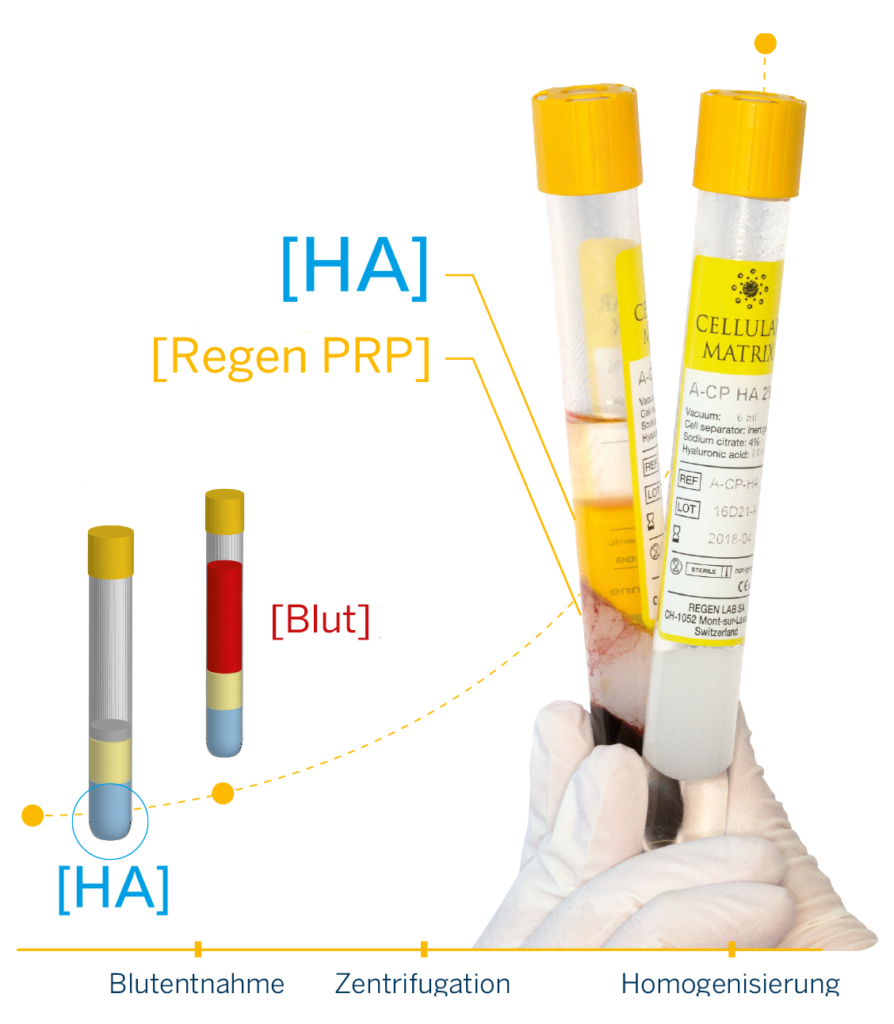 Home - CellularMatrix bei Kniearthrose